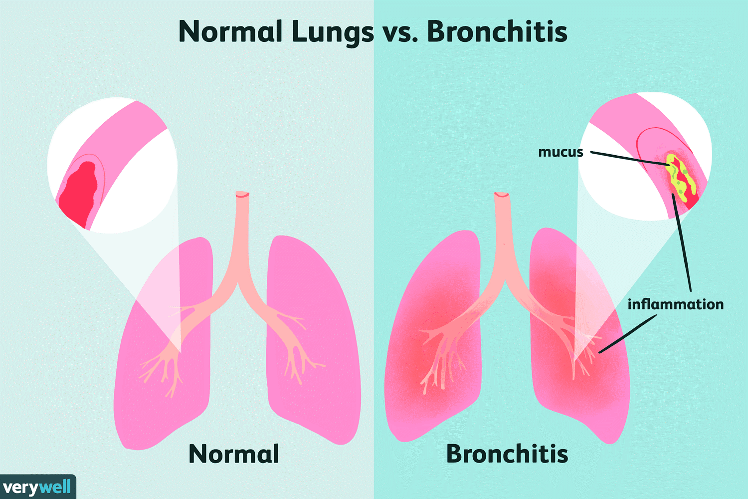 Bronchitis - InVite® Health Blog